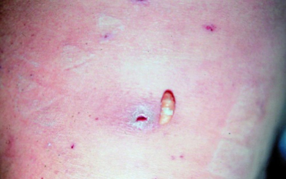 worms in face disease