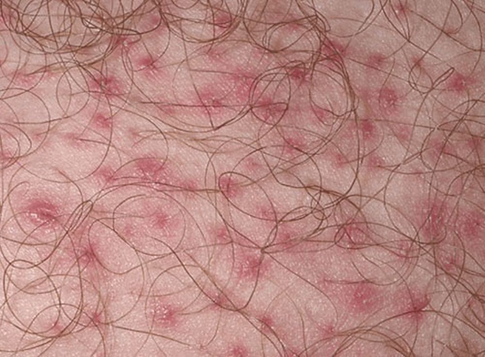 Pelos Encarnados Vaginales Infectados