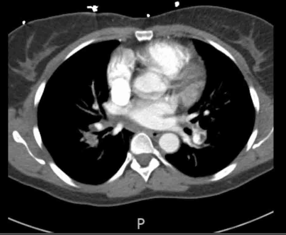 Chest Pain in a 49-yr-old Woman | Test Results 2 | Case Study 16 | The ...
