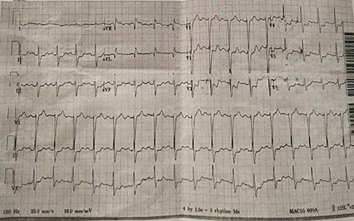 Chest Pain in 74-Yr-Old Man | Test Interpretation | Case Study 09 | The ...
